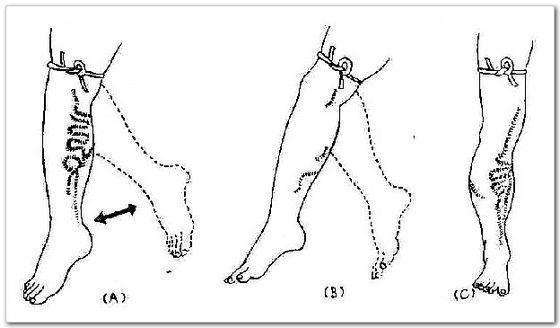 深静脉通畅试验图册_360百科