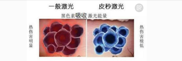 皮秒激光祛斑维持多久皮秒蜂巢做几次才有效果360新知