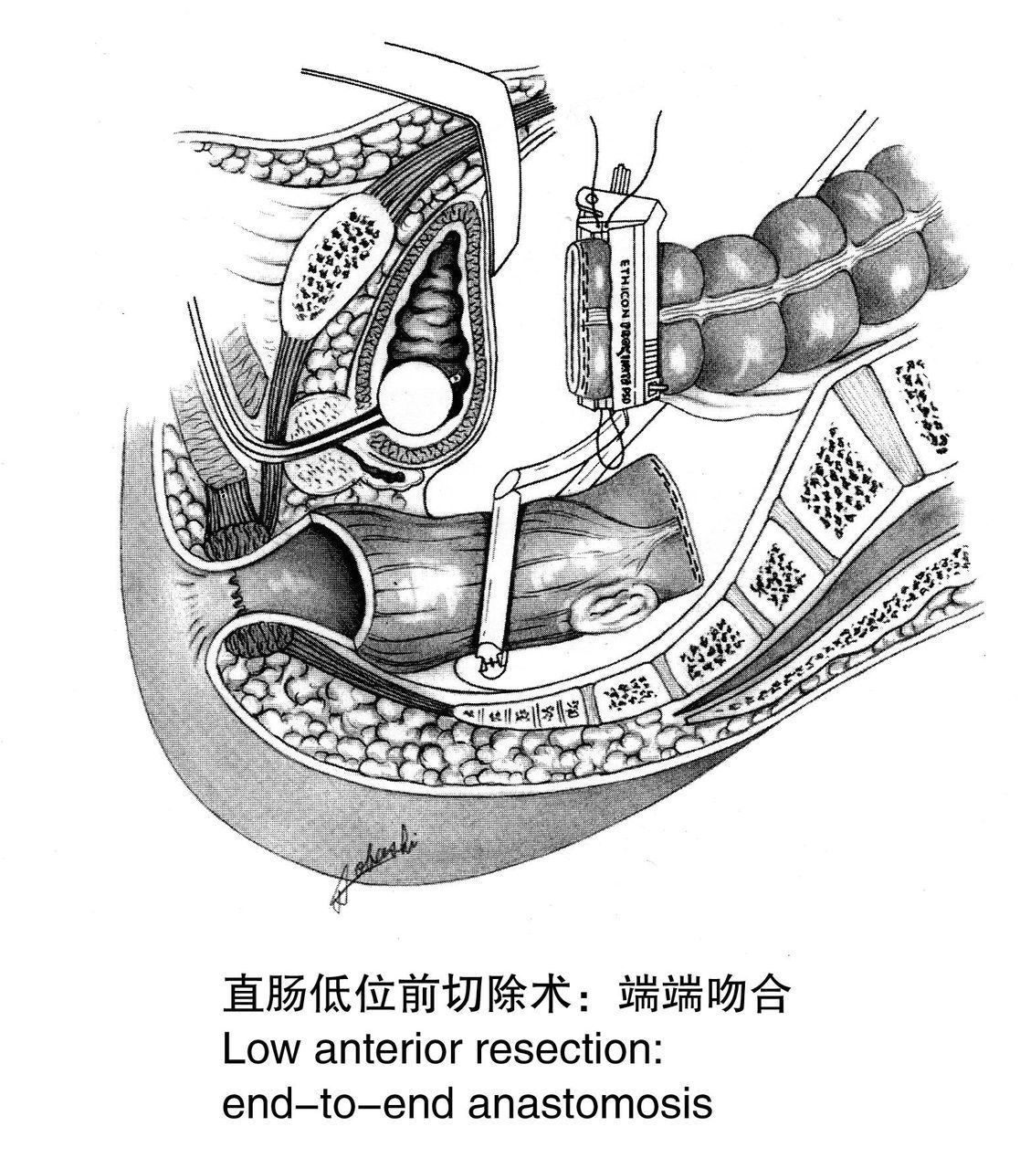 Dixon手术图册_360百科