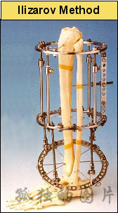 Ilizarov技术图册_360百科