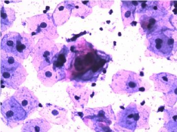 TCT筛查图册_360百科