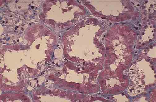 Alport综合症图册_360百科