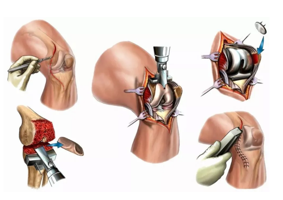 人工全膝关节置换术图册_360百科