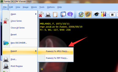 dcm格式图像怎么打开并保存为Jpg格式_360新知