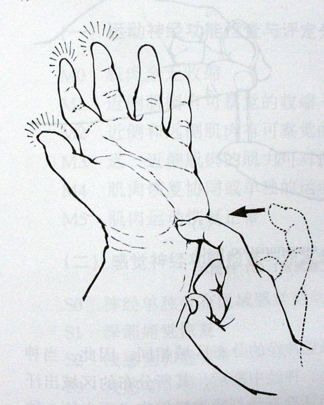 tinel征图册_360百科