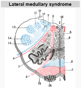Wallenberg综合症图册_360百科